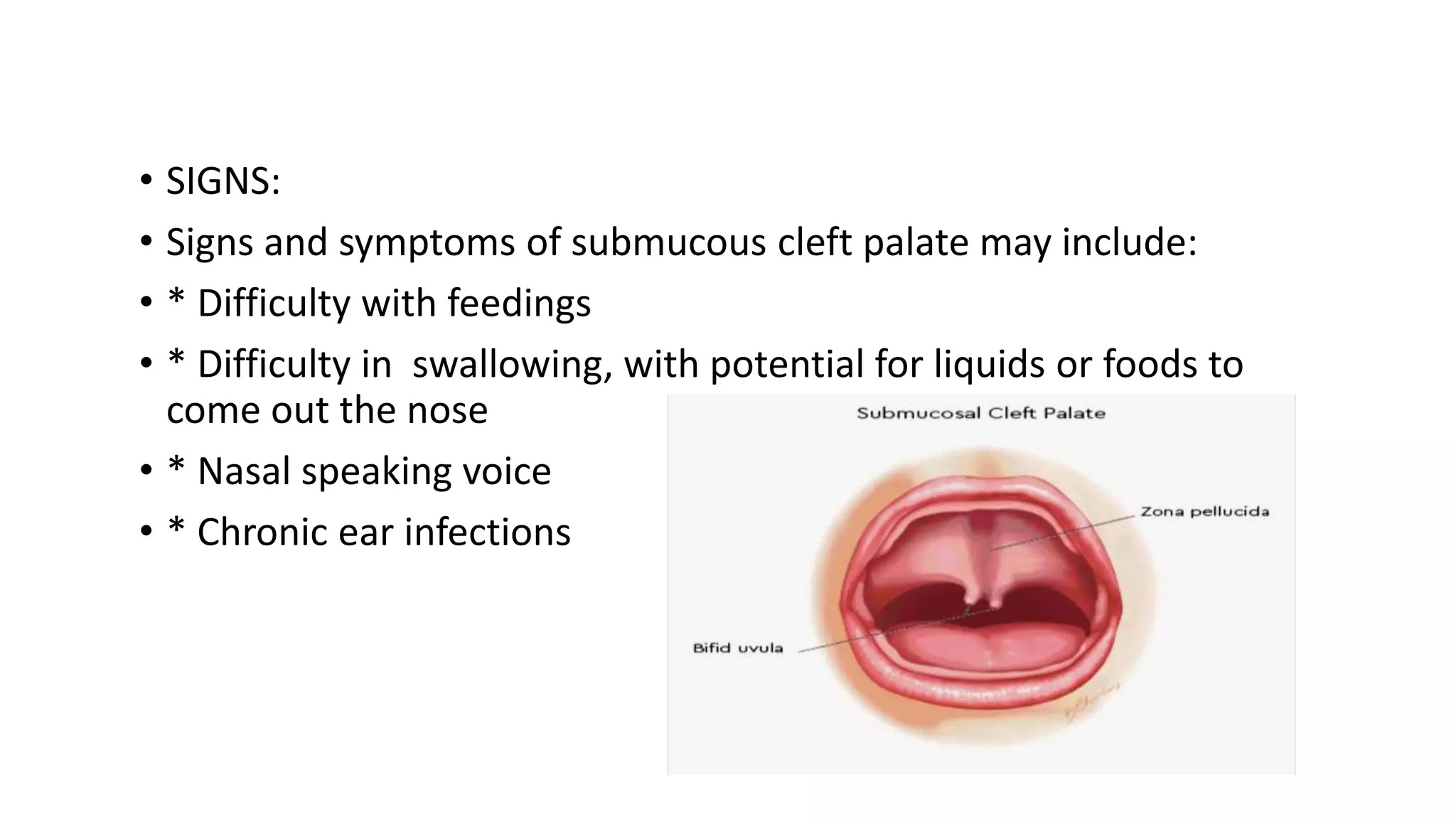 Cleft palate | PPTX