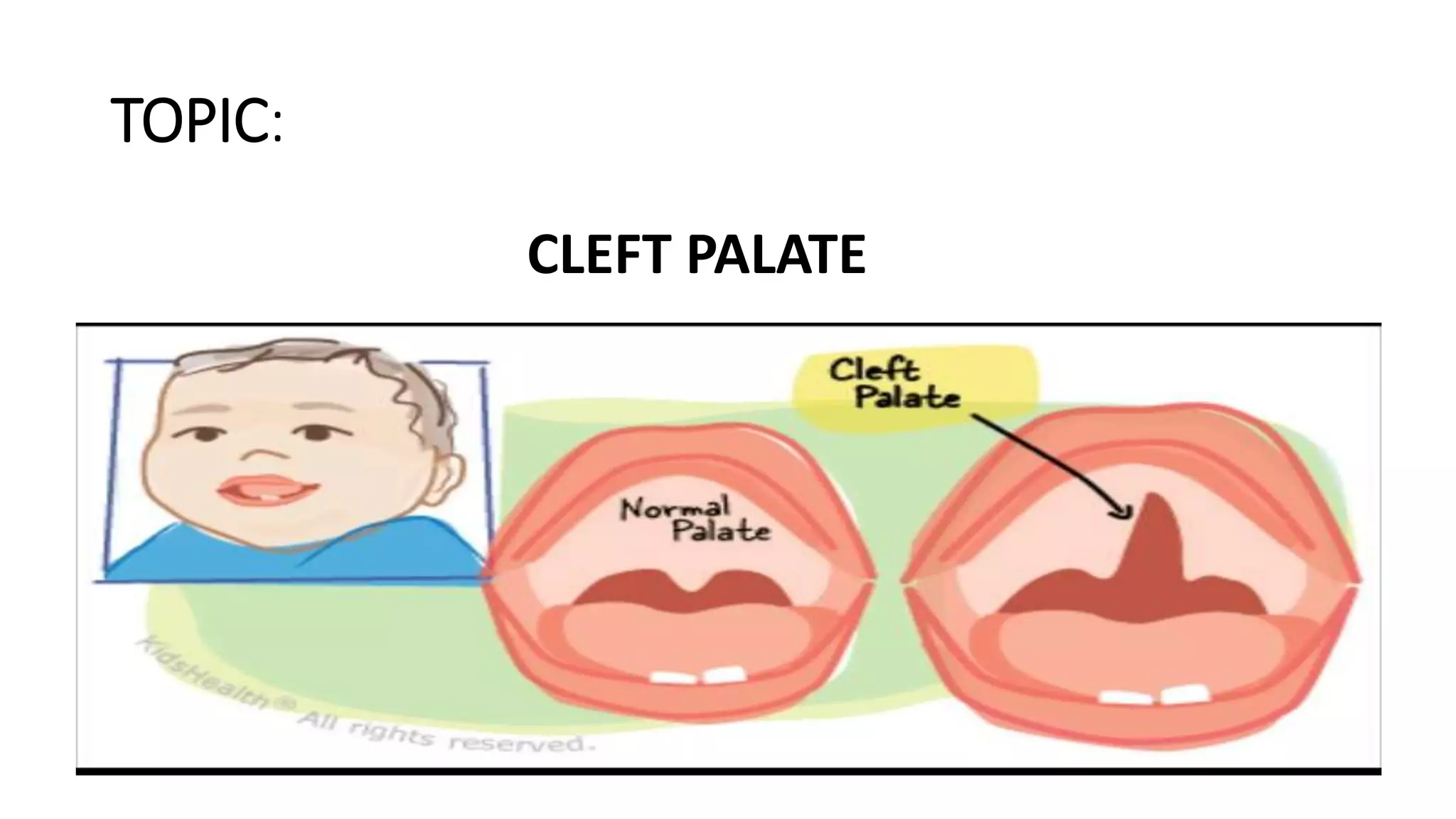 Cleft palate | PPTX
