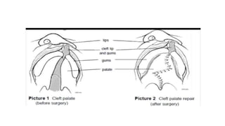 cleftpalate-power point preeentation (1).pdf