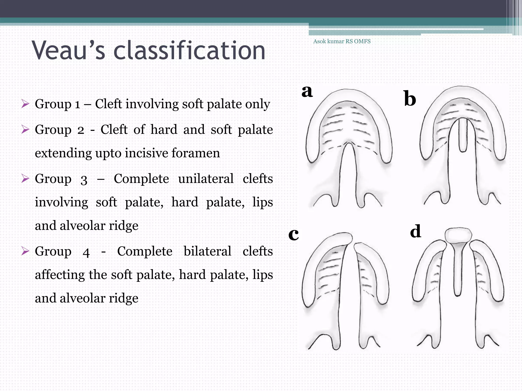 Cleft palate | PDF