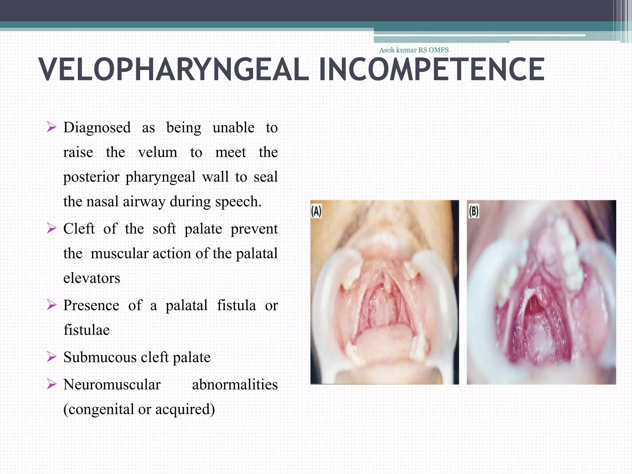 Cleft palate | PDF