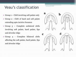 Cleft palate | PPT