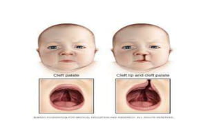 cleft palate. pptx | PPTX