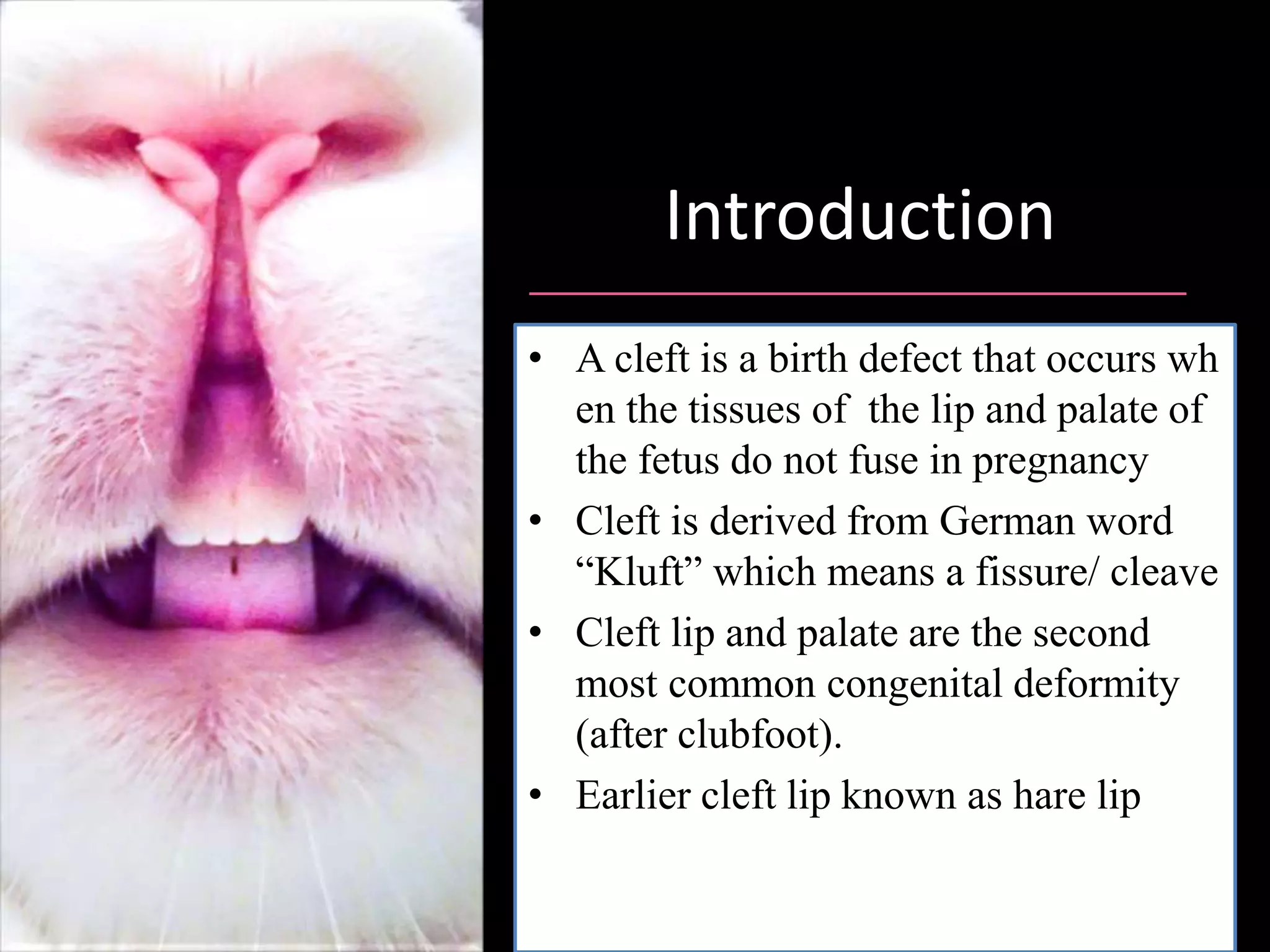 Cleft palate final.pptx