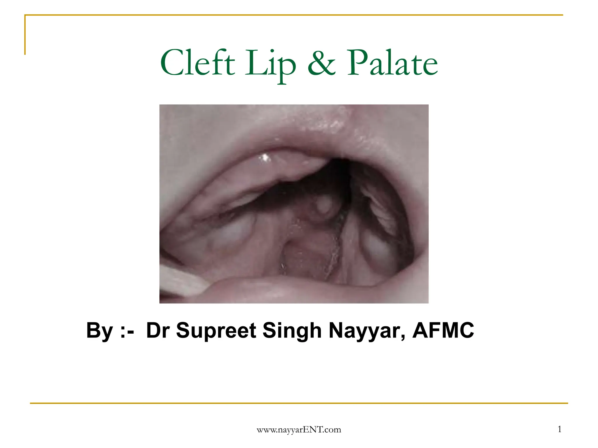 Cleft Palate Lip Bifid uvula submucosal cleft modified by Dr Nayyar.ppt ...
