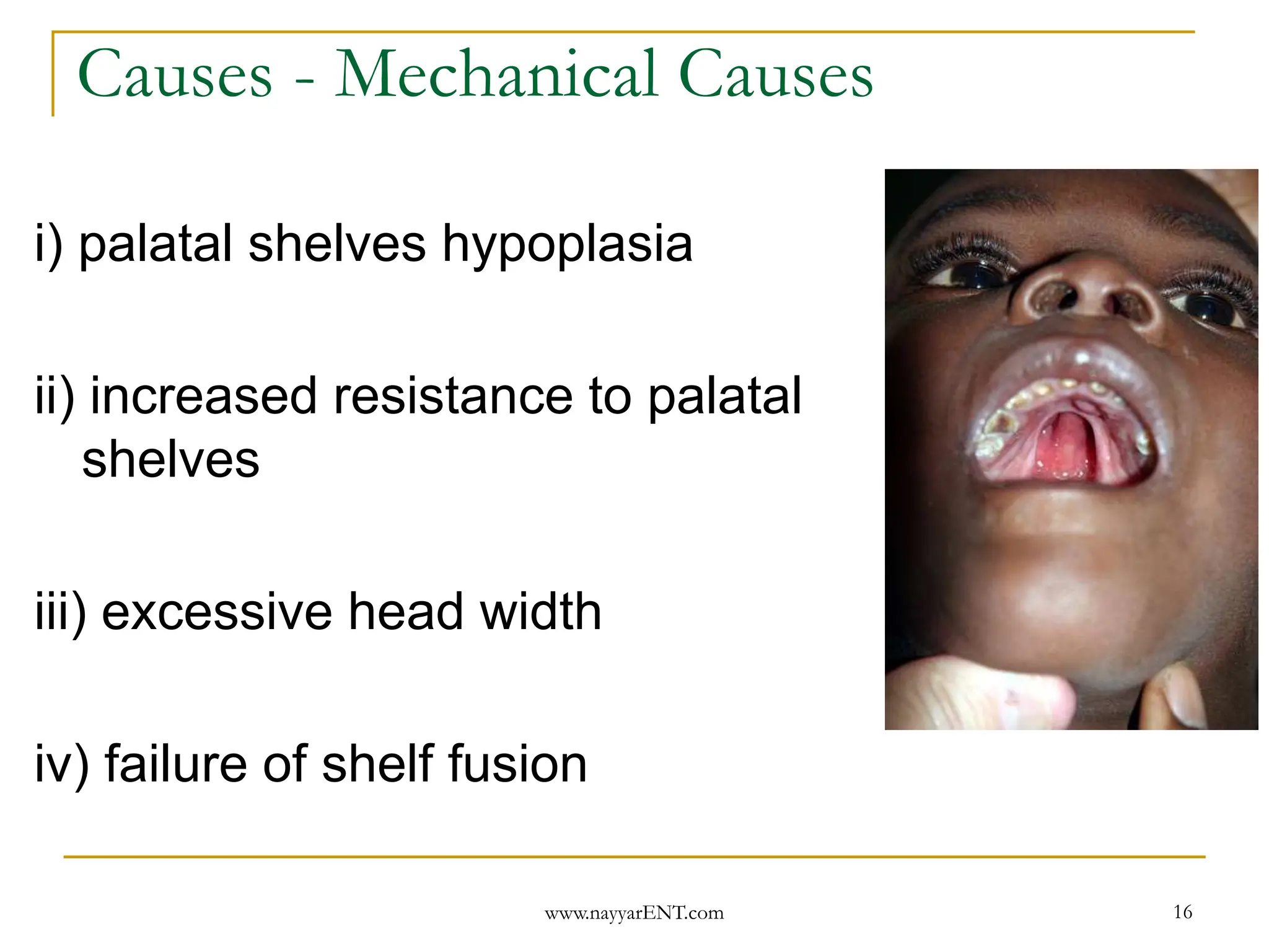 Cleft Palate Lip Bifid uvula submucosal cleft modified by Dr Nayyar.ppt
