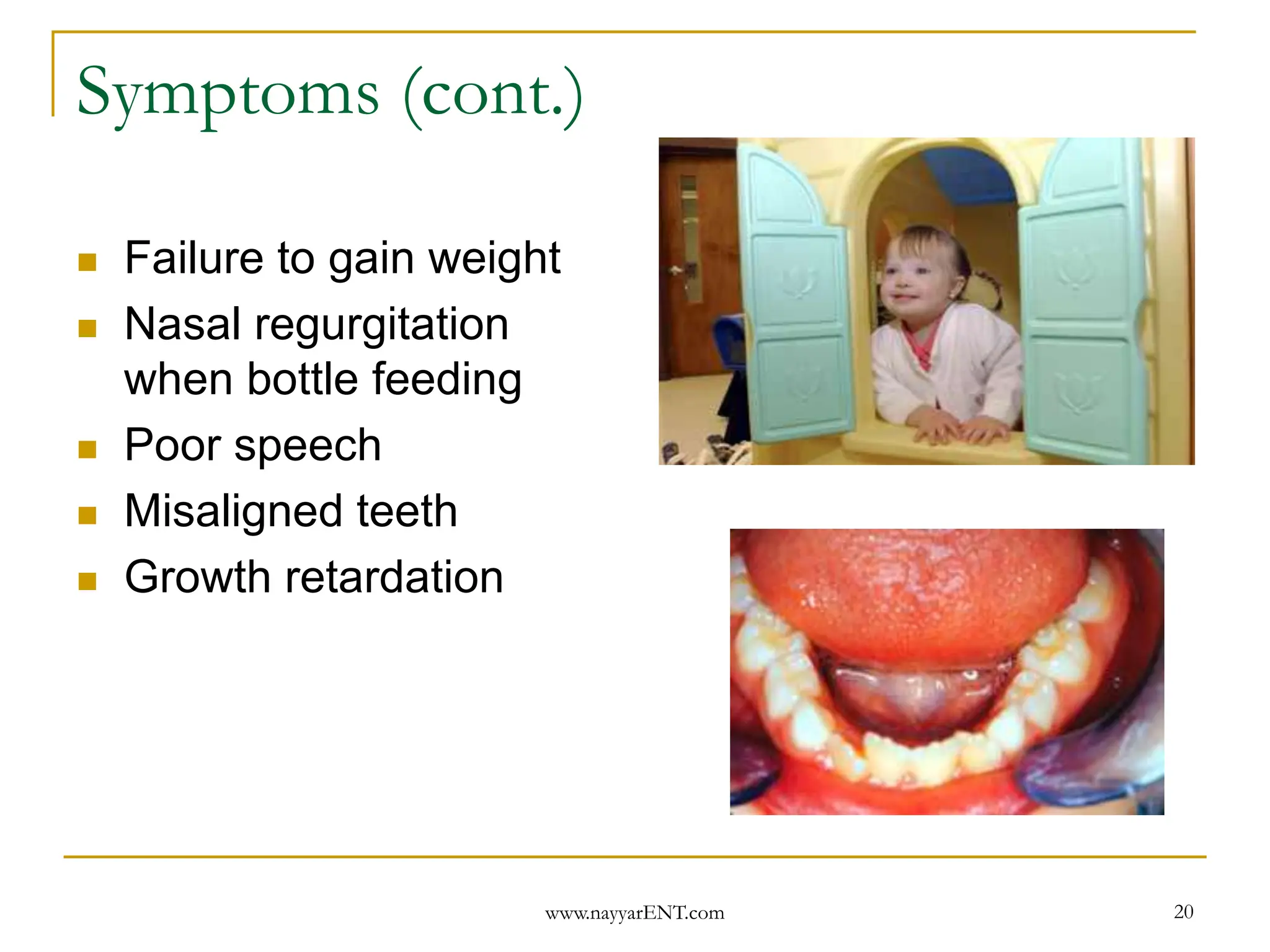 Cleft Palate Lip Bifid uvula submucosal cleft modified by Dr Nayyar.ppt