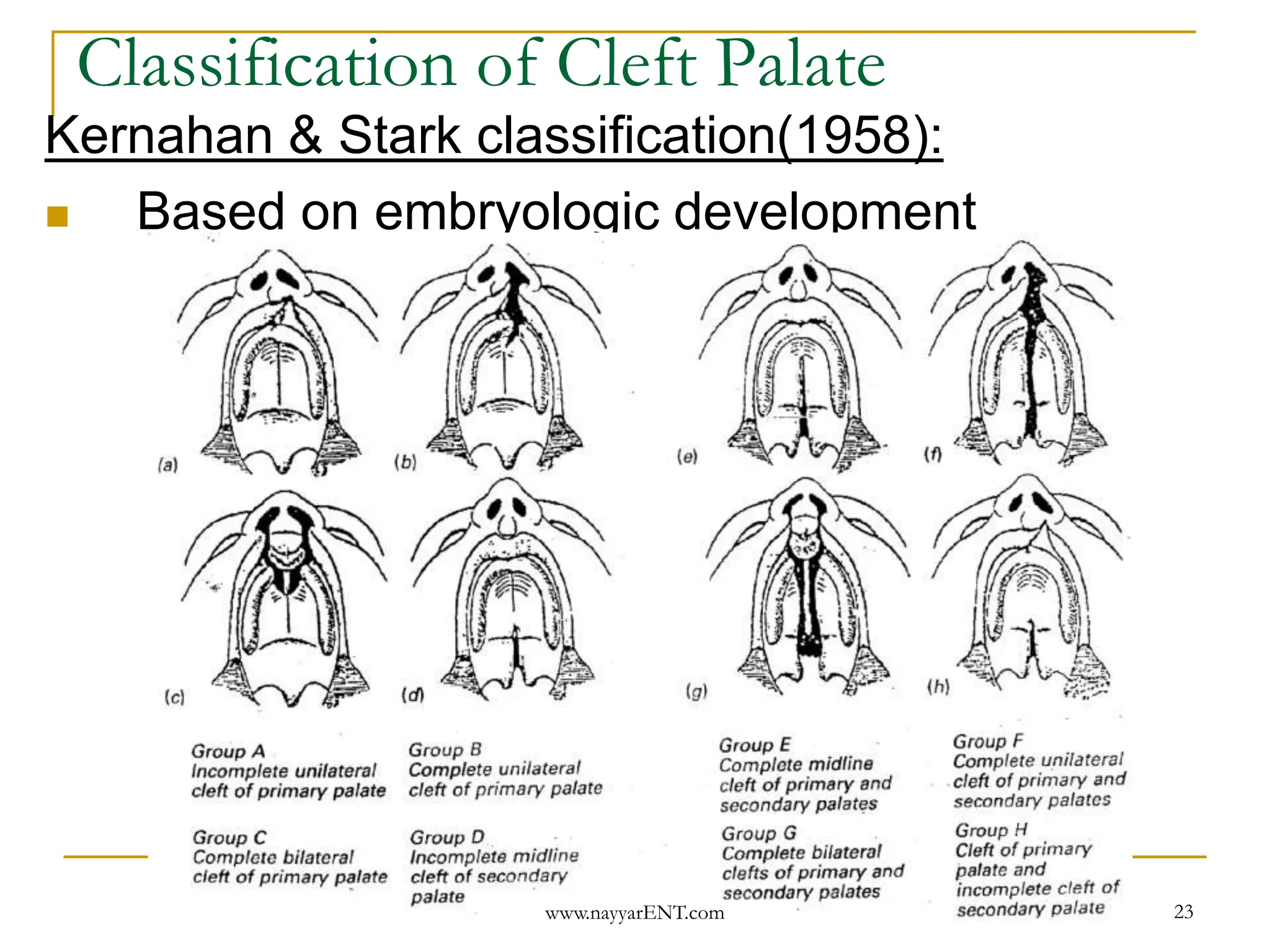Cleft Palate Lip Bifid uvula submucosal cleft modified by Dr Nayyar.ppt