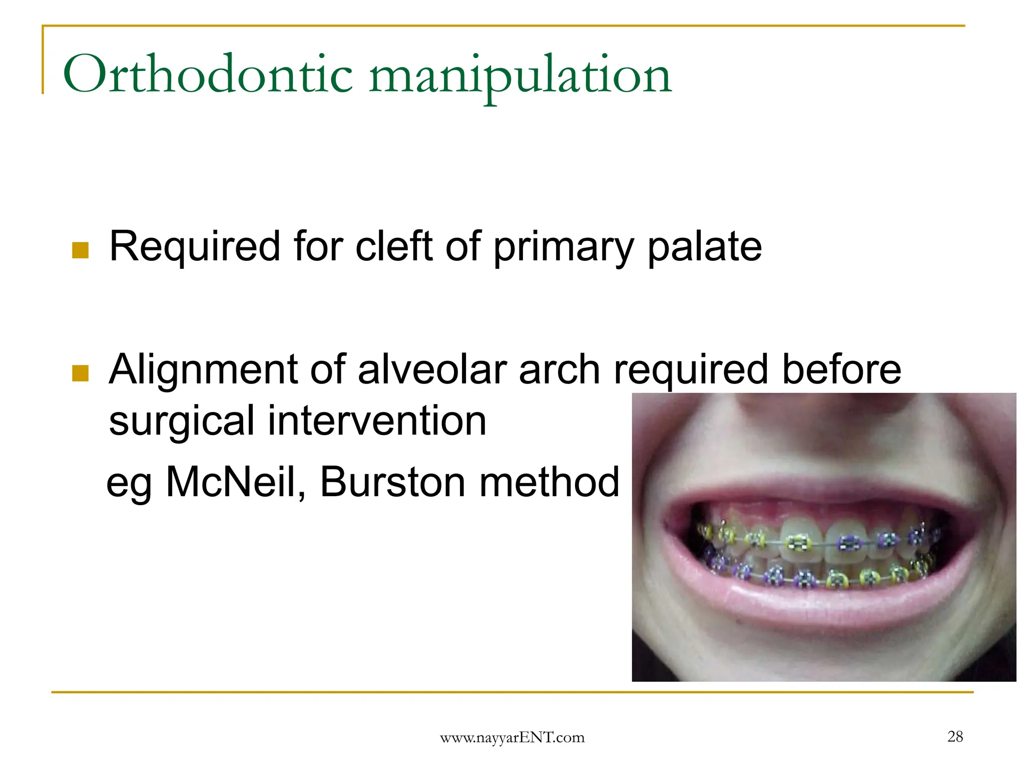 Cleft Palate Lip Bifid uvula submucosal cleft modified by Dr Nayyar.ppt