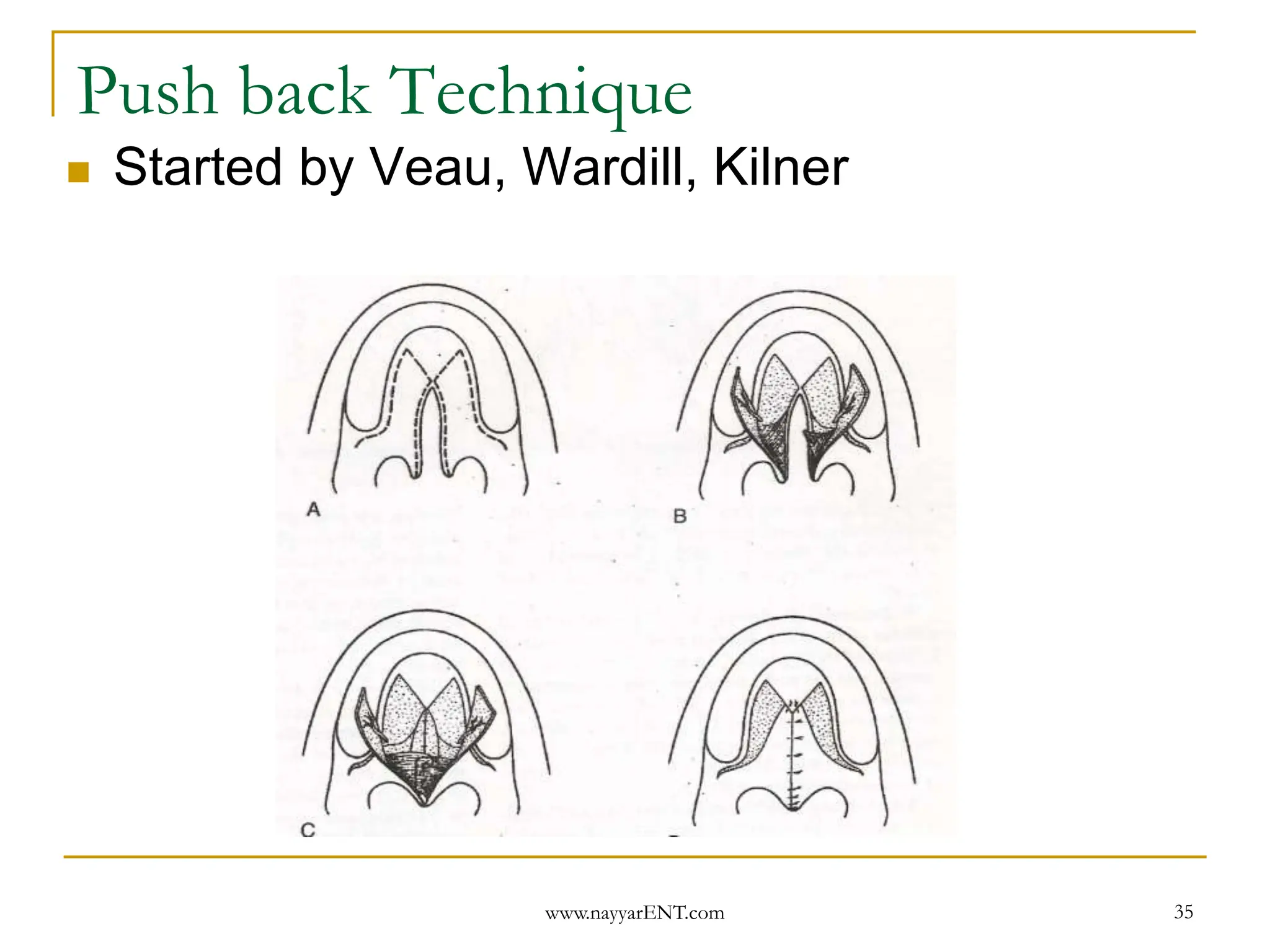 Cleft Palate Lip Bifid uvula submucosal cleft modified by Dr Nayyar.ppt