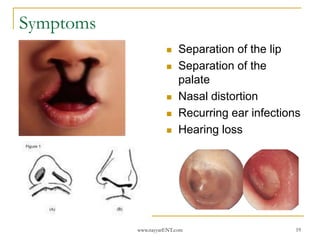 Cleft Palate Lip Bifid uvula submucosal cleft modified by Dr Nayyar.ppt