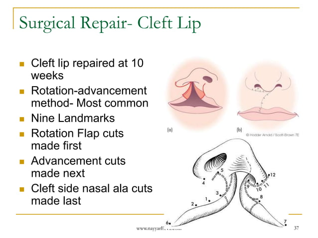 Cleft Palate Lip Bifid uvula submucosal cleft modified by Dr Nayyar.ppt ...