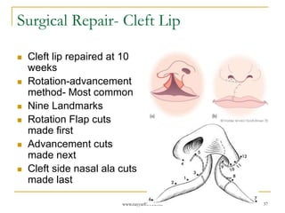 Cleft Palate Lip Bifid uvula submucosal cleft modified by Dr Nayyar.ppt