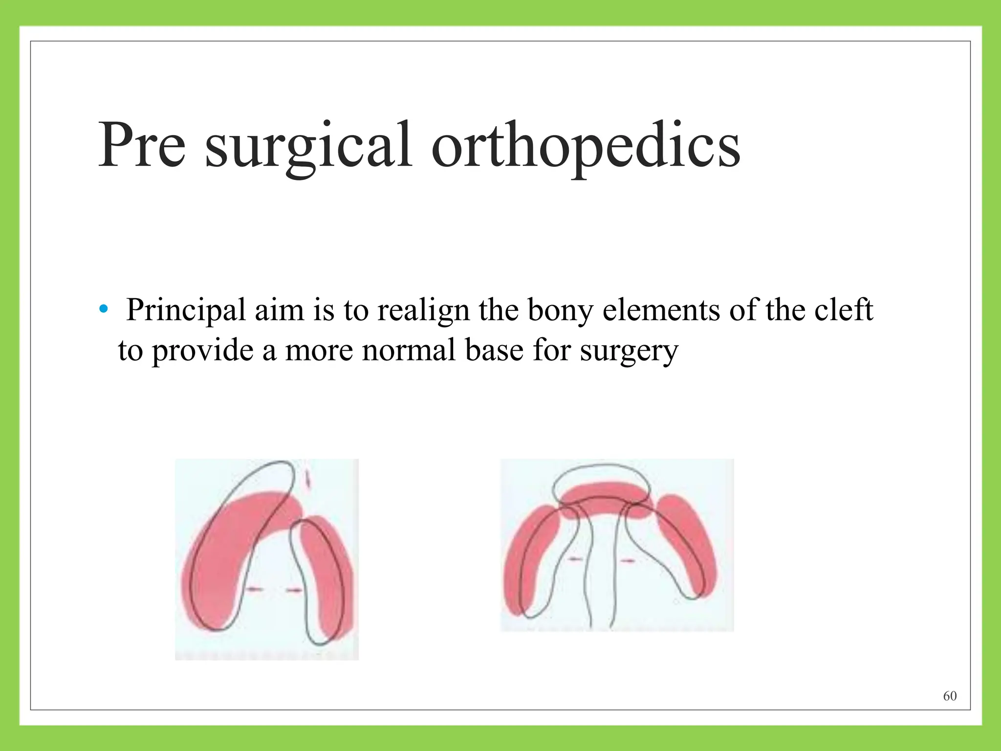 cleft lip and Cleft Palate Rehabilitation | PPTX