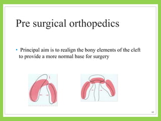 cleft lip and Cleft Palate Rehabilitation | PPTX