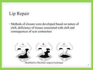 cleft lip and Cleft Palate Rehabilitation | PPTX