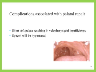 cleft lip and Cleft Palate Rehabilitation | PPTX