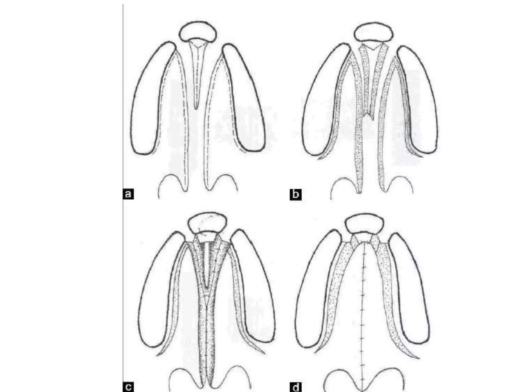 Cleft Palate Repair Ppt