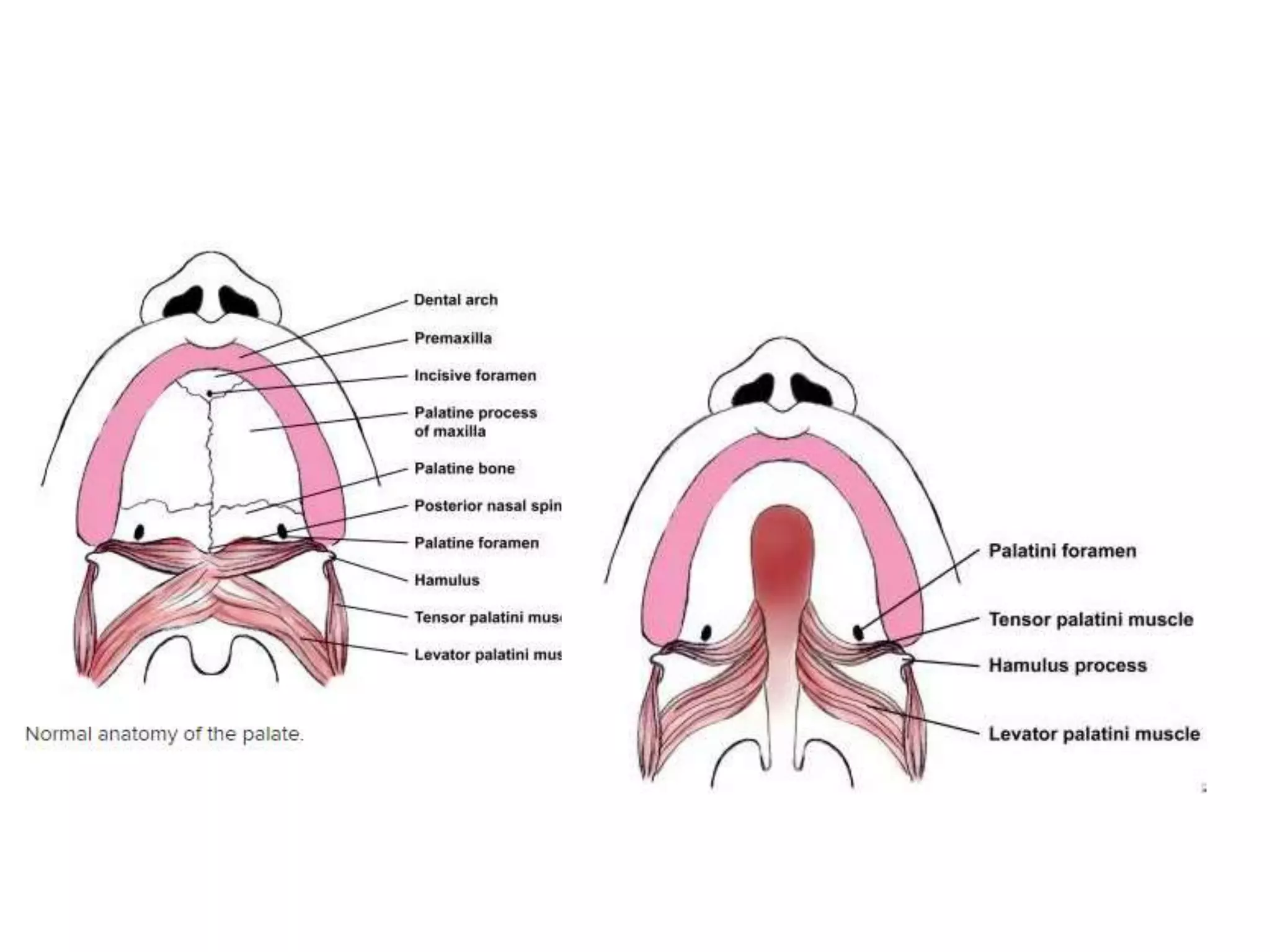 Cleft palate repair | PPTX