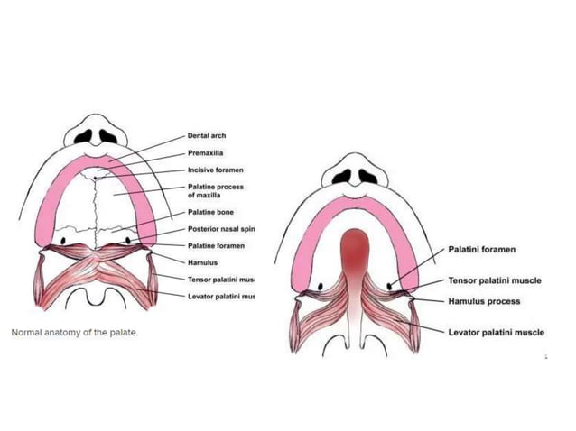 Cleft palate repair | PPTX | Ear, Nose and Throat Conditions | Diseases ...
