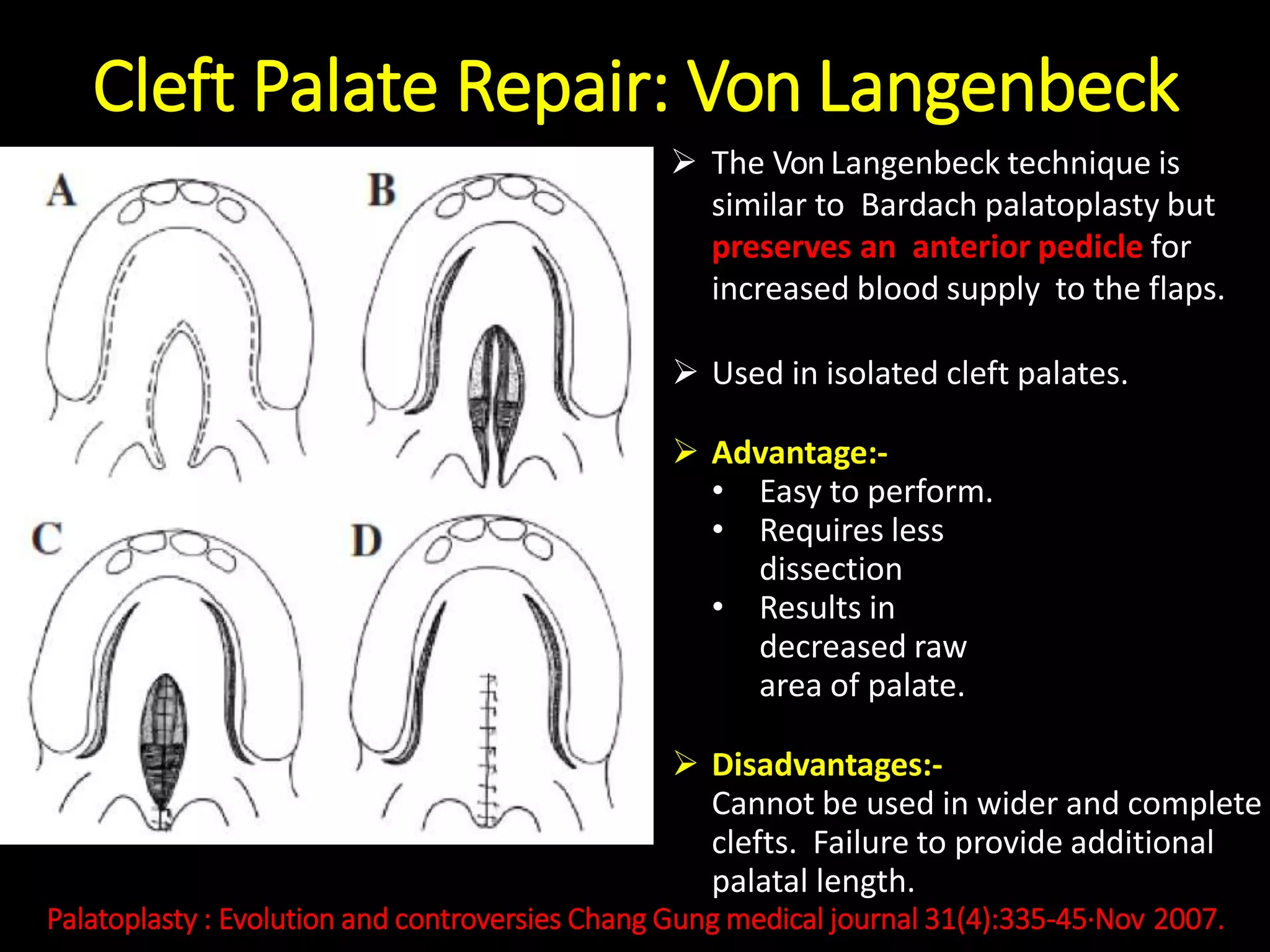 Cleft Palate & It's Management | PPTX