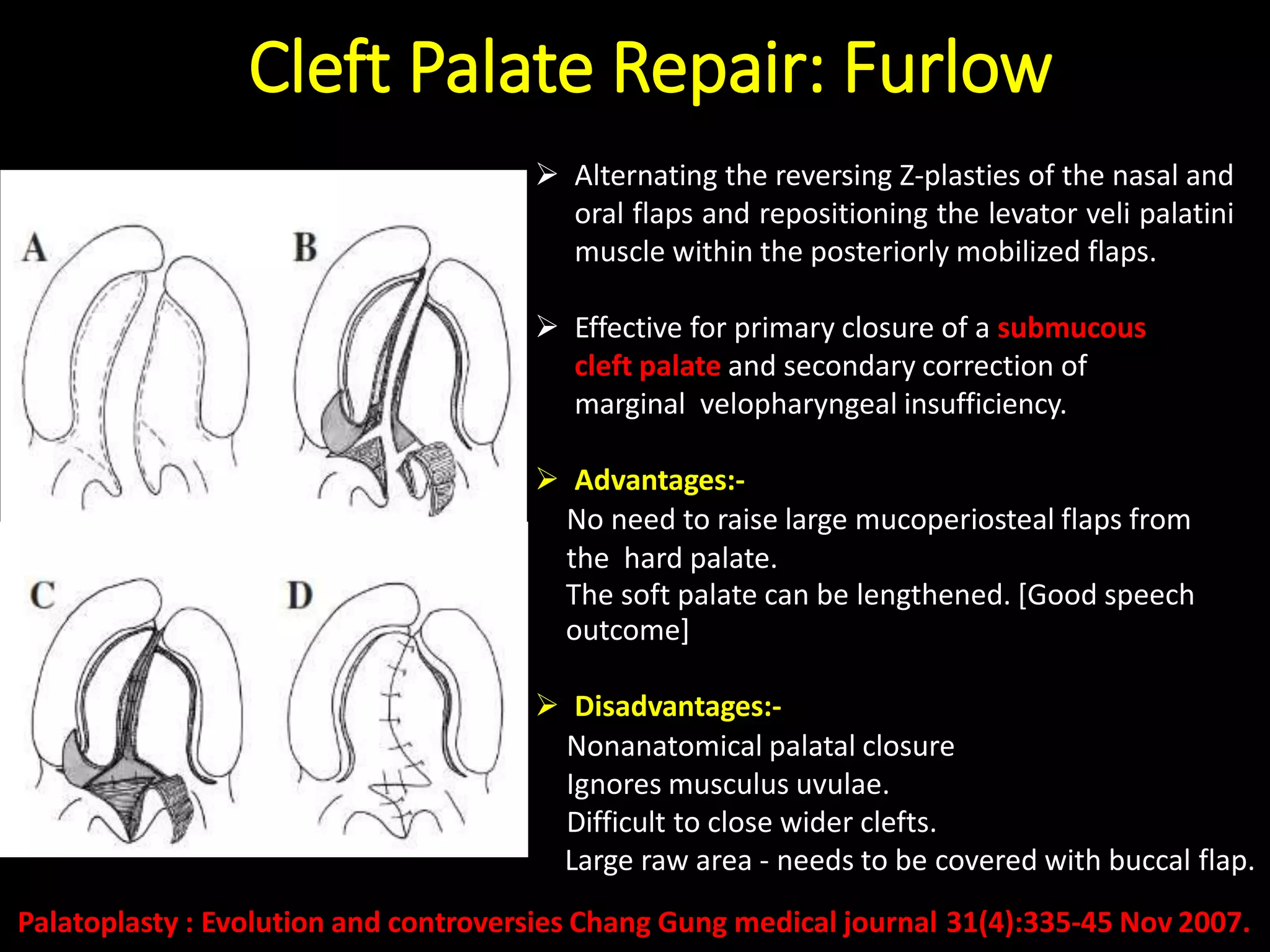 Cleft Palate & It's Management | PPTX