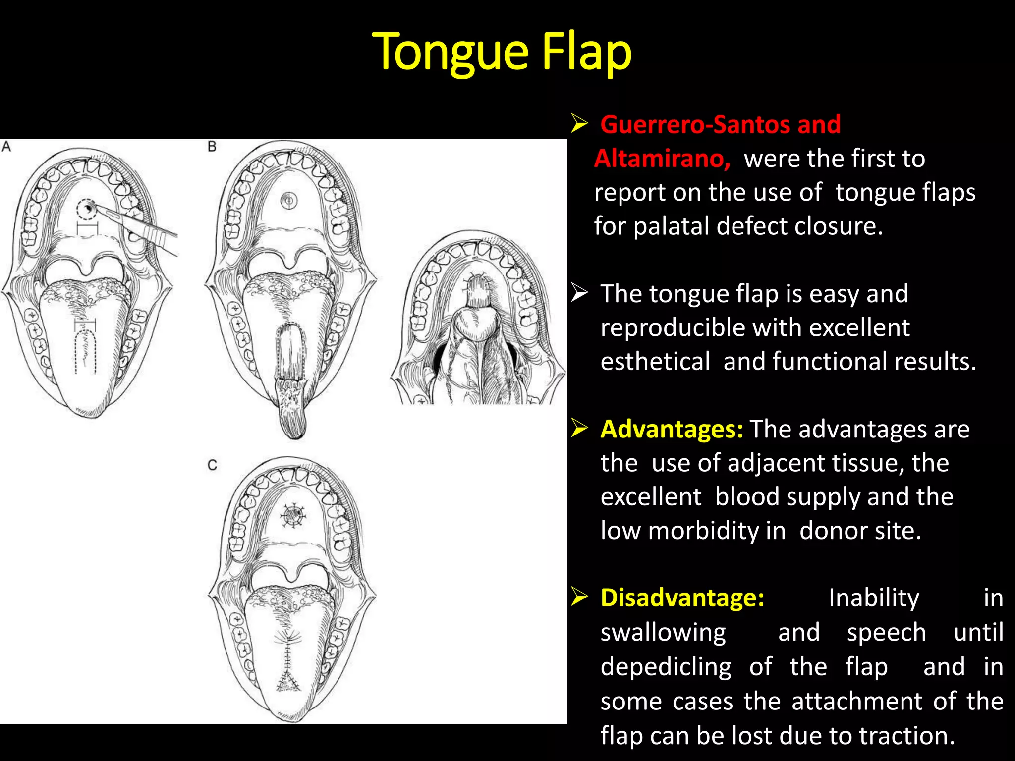 Cleft Palate & It's Management | PPTX