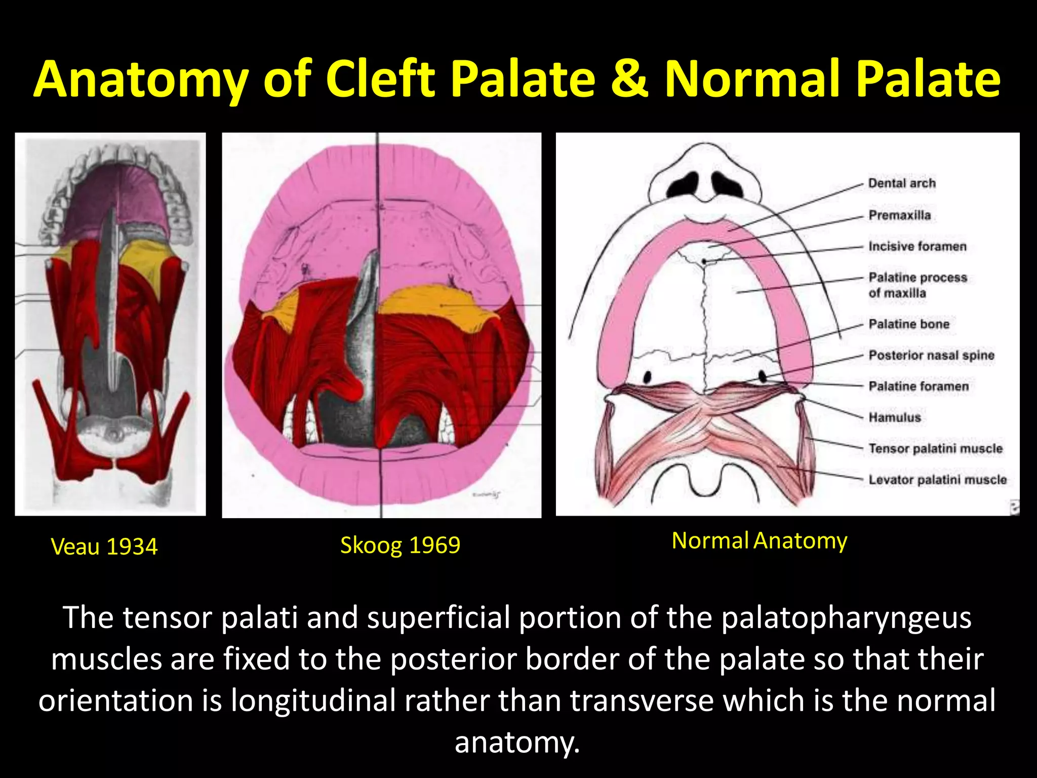 Cleft Palate & It's Management | PPTX