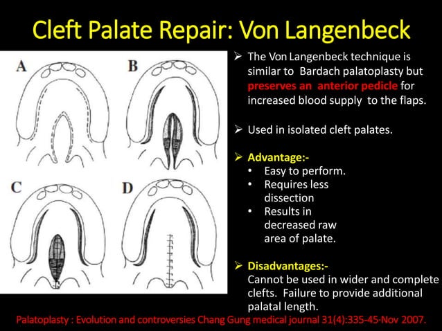 Cleft Palate & It's Management | PPTX