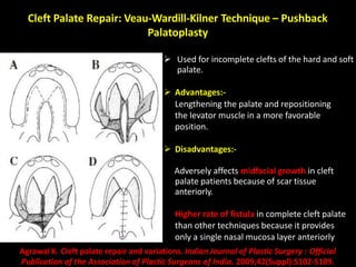 Cleft Palate & It's Management | PPTX
