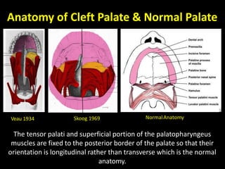 Cleft Palate & It's Management | PPTX
