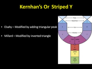 Cleft Palate & It's Management | PPTX