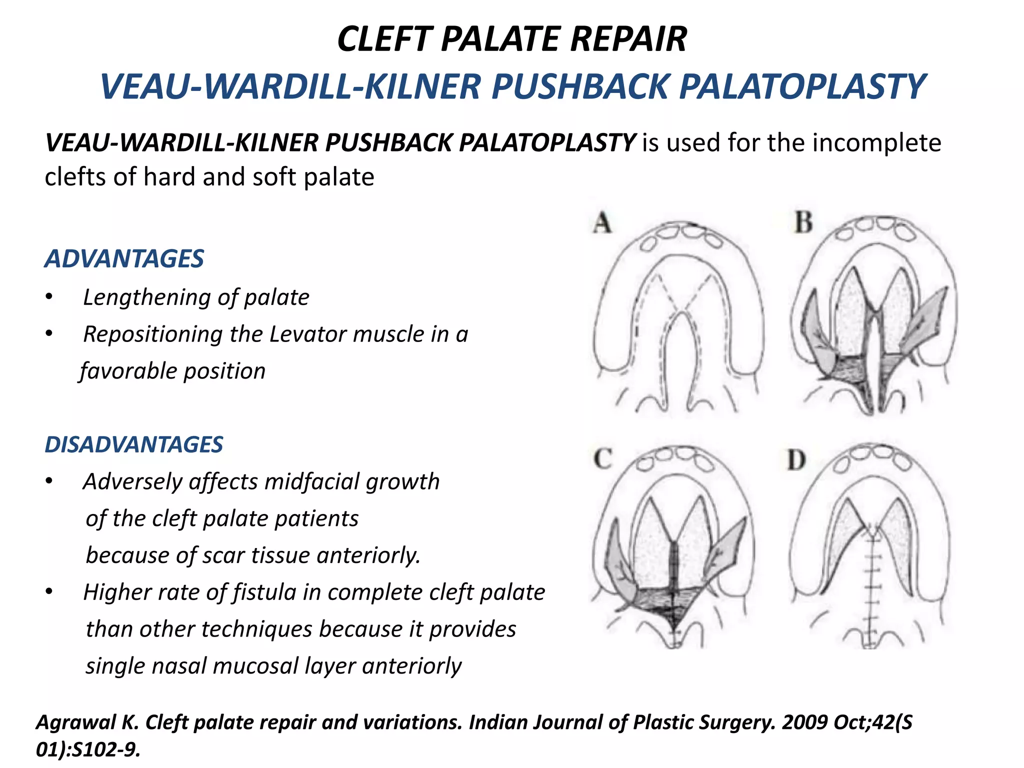 CLEFT LIP AND PALATE PART 3 - SURGICAL.pptx