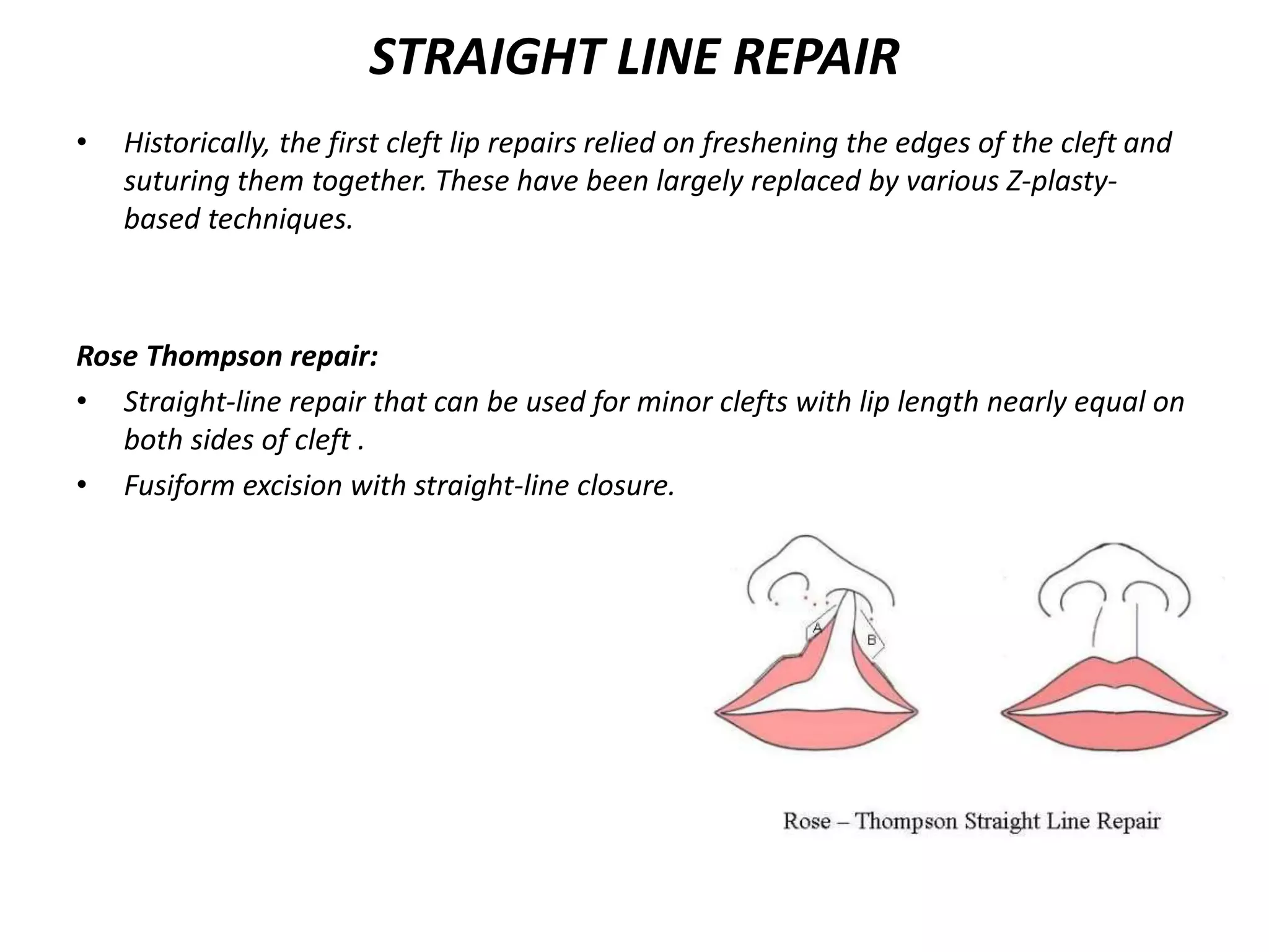 CLEFT LIP AND PALATE PART 3 - SURGICAL.pptx