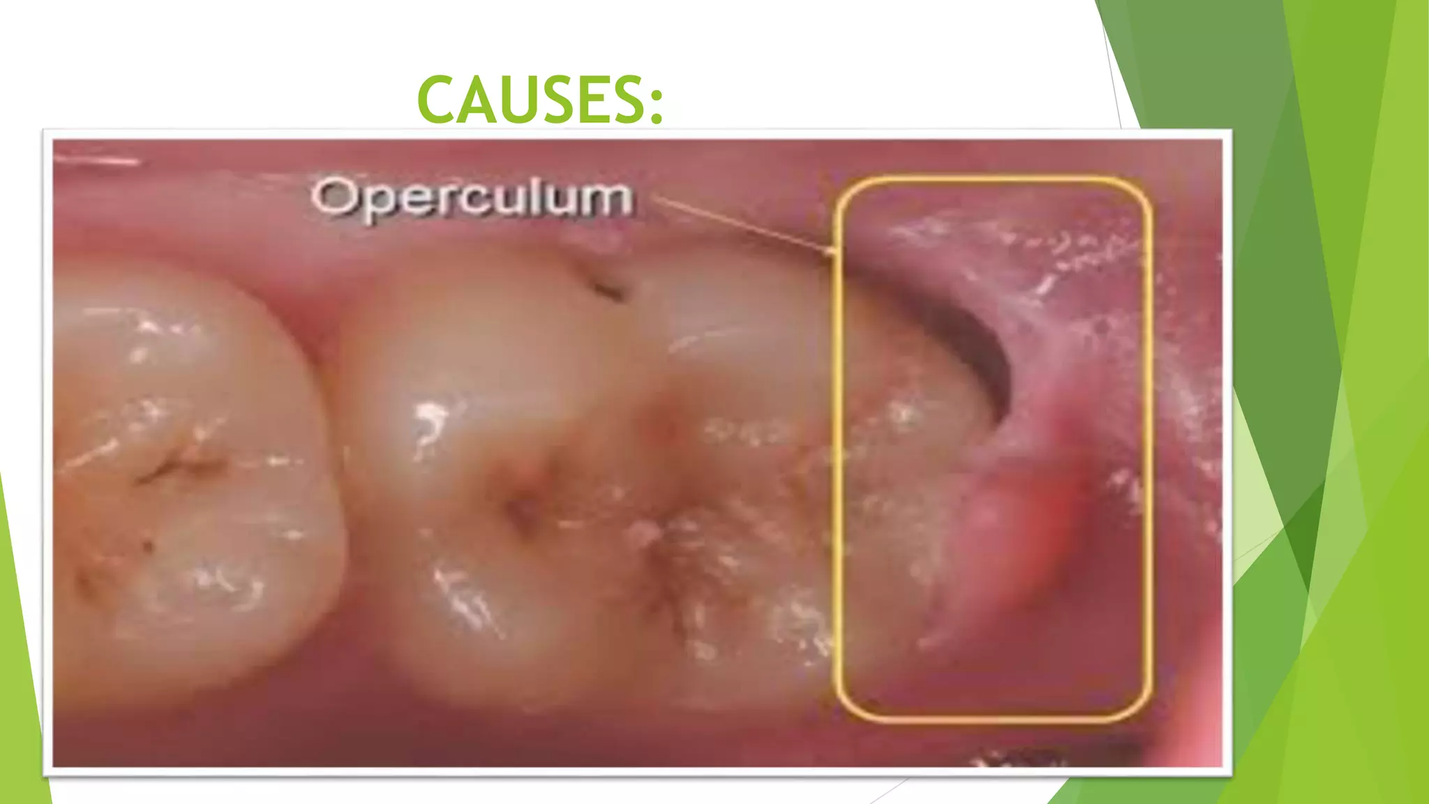 common oral disease and condition | PPTX