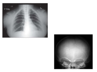 Cleidocranial Dysplasia Radiology