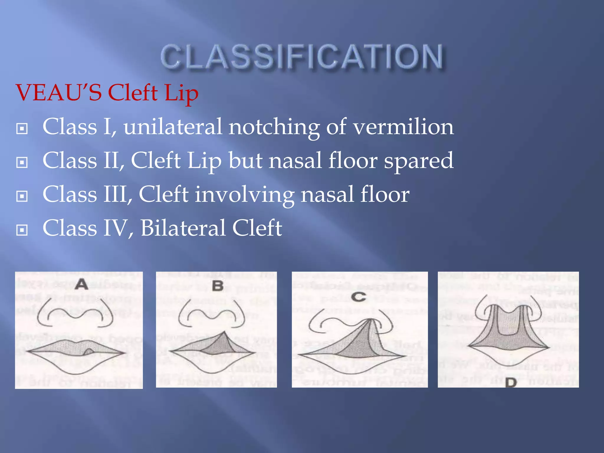 Clet lip and palate | PPTX