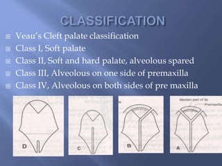Clet lip and palate | PPTX