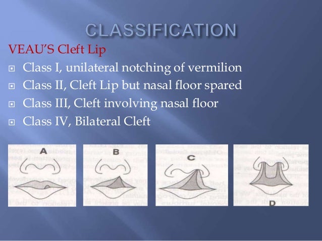Clet lip and palate
