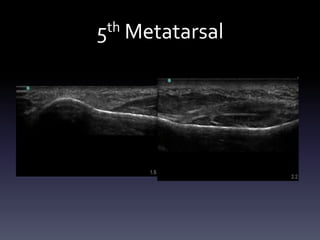Quadriceps Tendon Ultrasound