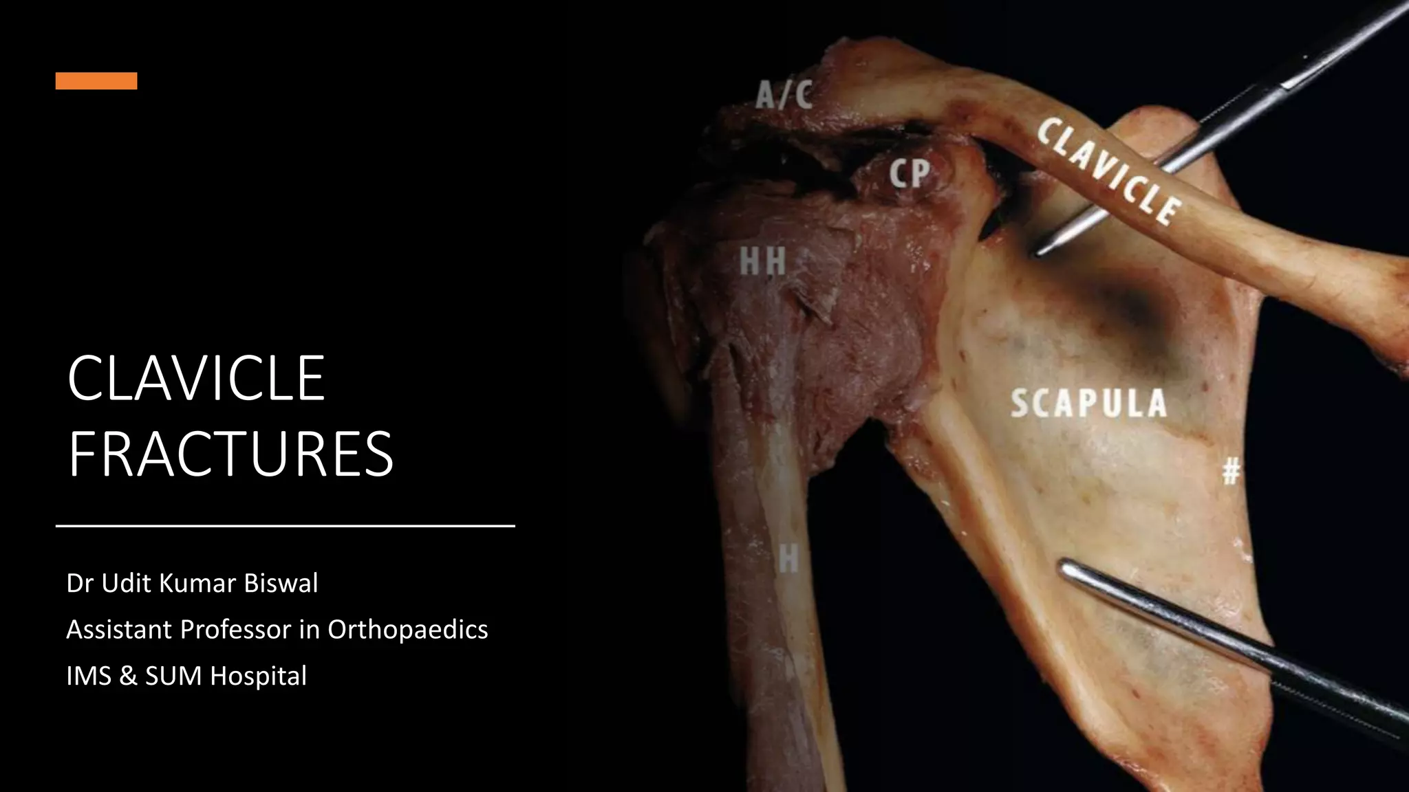 clavicle fracture.pptx | Death, Injury, or Military Conflict ...