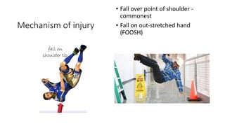 clavicle fracture.pptx