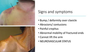 clavicle fracture.pptx | Death, Injury, or Military Conflict ...