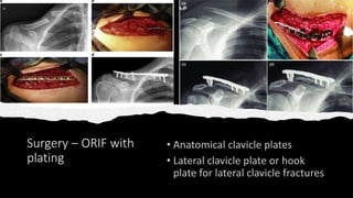 clavicle fracture.pptx