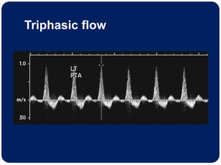 Chronic Limb Threatening Ischemia (PVD).pptx