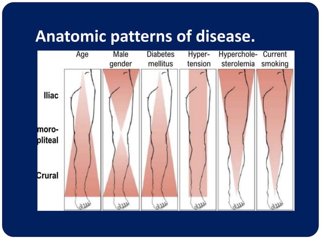 Chronic Limb Threatening Ischemia (PVD).pptx | Medical Health
