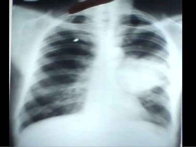 cliché thoracique avec interpretation