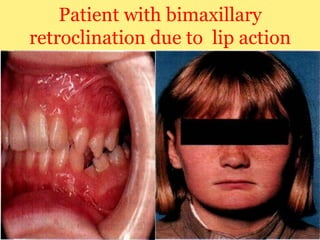 class ii division 2 malocclusion | PPTX