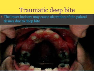 class ii division 2 malocclusion | PPTX