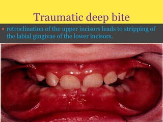 class ii division 2 malocclusion | PPTX